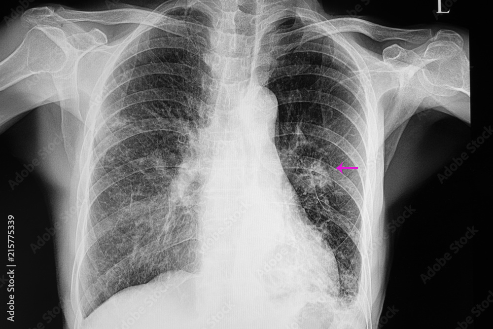Chest xray of patient with pneumonia and lung nodule Stock Photo ...