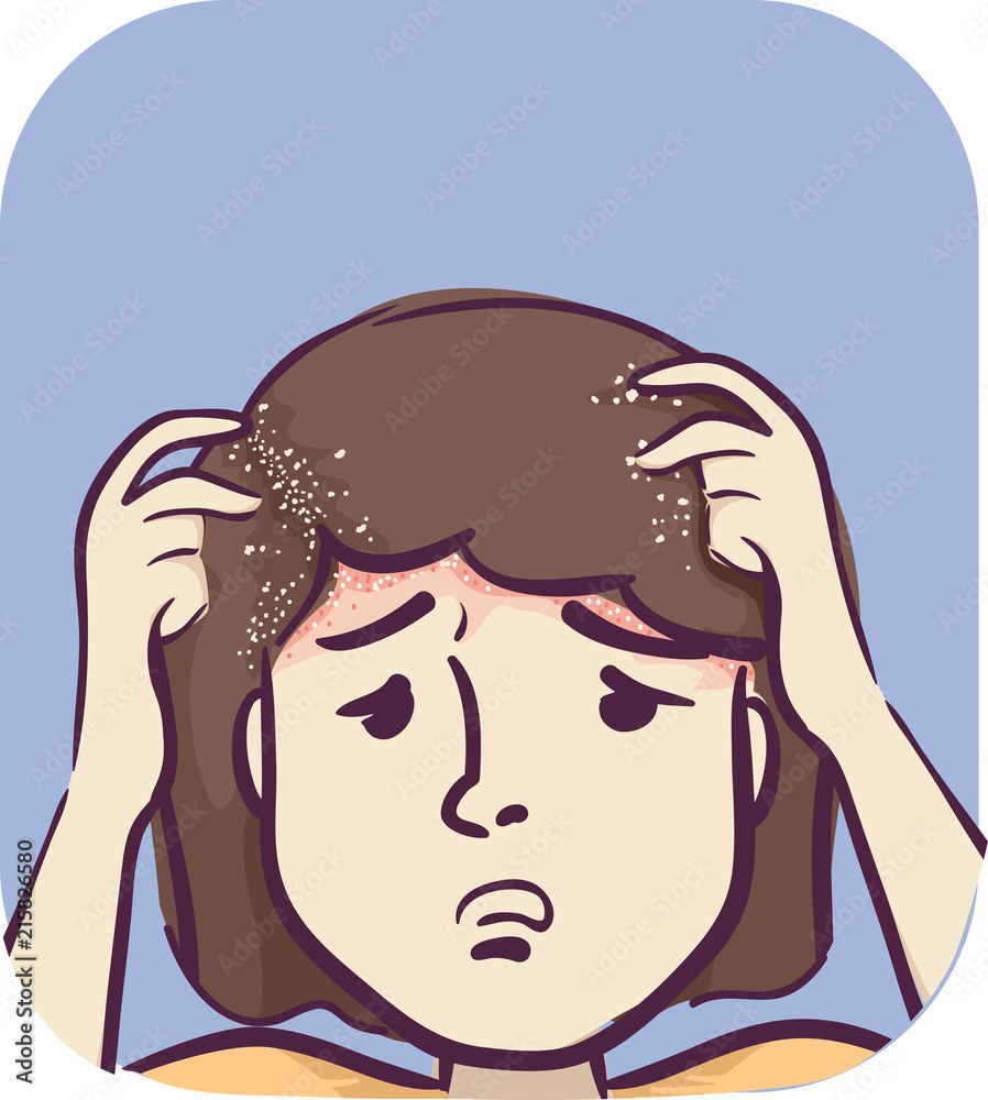 Symptoms Girl Head Dandruff Flaky Skin Stock Vector | Adobe Stock