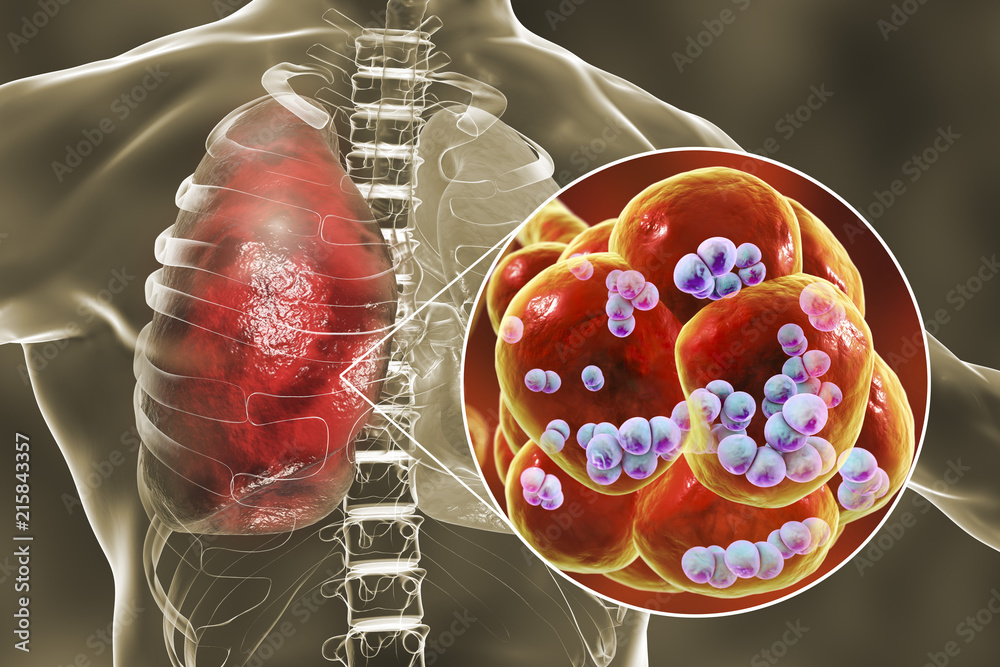Pneumococcal pneumonia, medical concept. 3D illustration showing ...