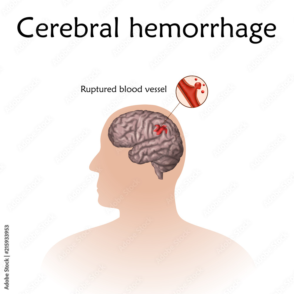Cerebral hemorrhage poster, banner. Vector medical illustration. white ...
