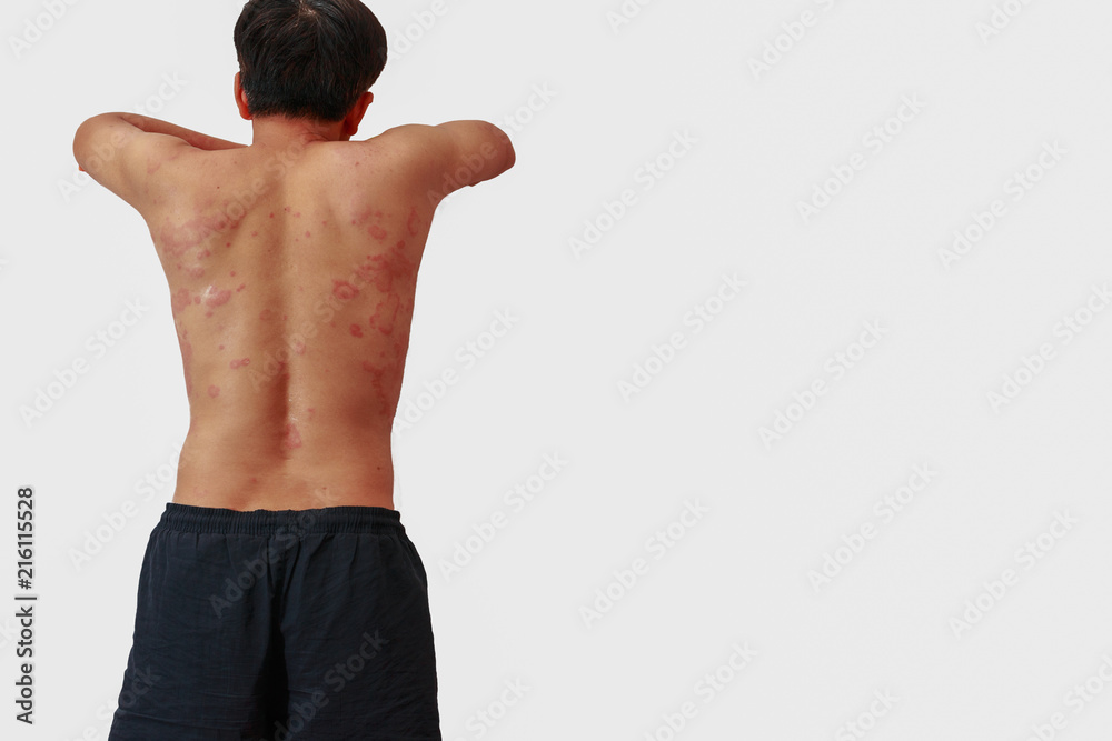 Man with dermatitis problem of rash ,Allergy rash on white background ...