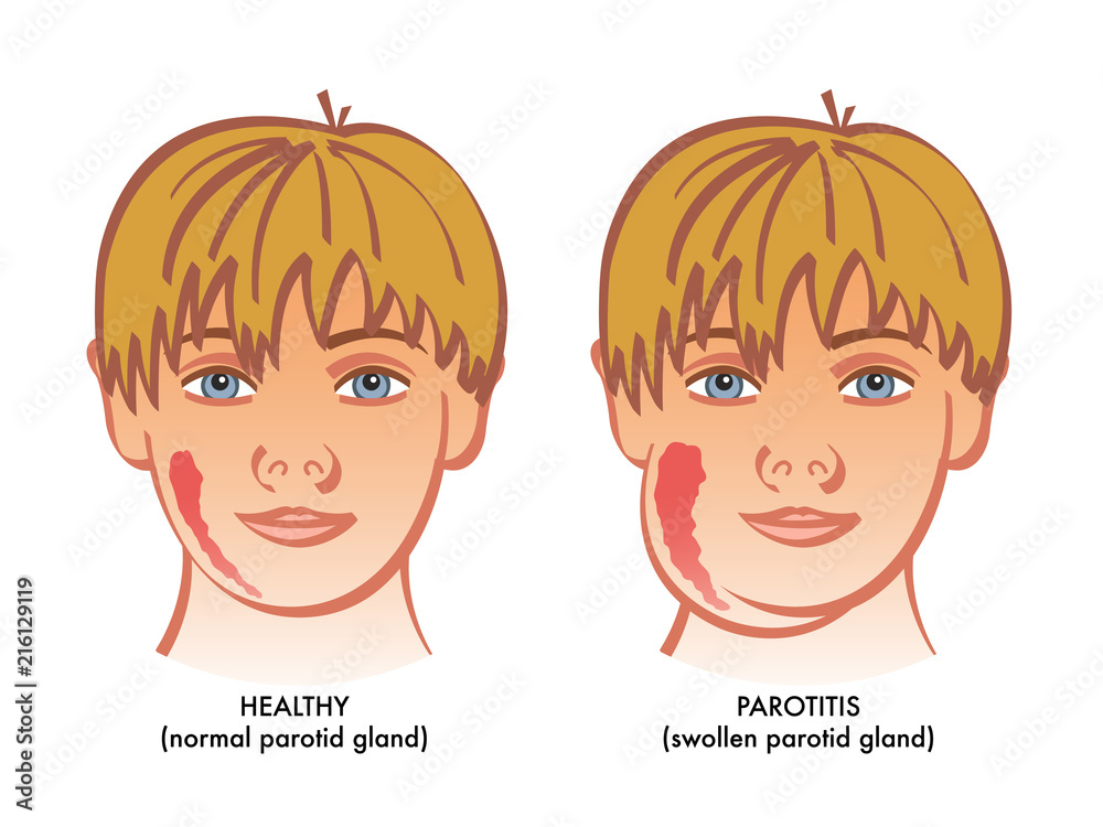Vecteur Stock A vector medical illustration showing a healthy child ...