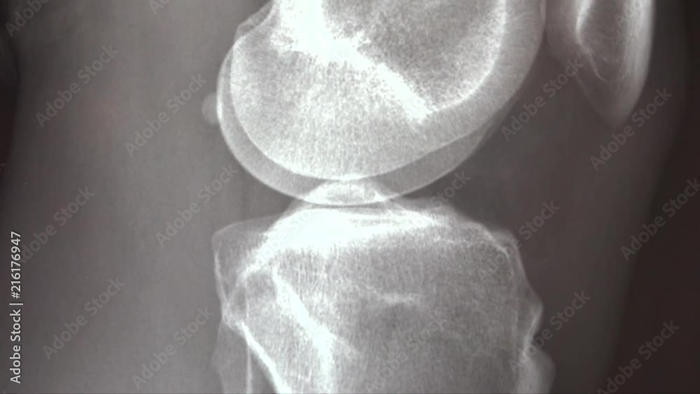 X ray of knee joint anatomy with tibia and fibula leg bones CLOSE UP ...