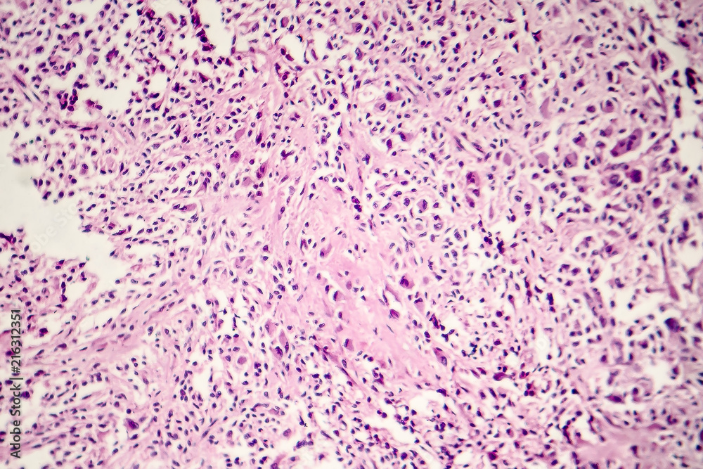 Foreign body granuloma, light micrograph, photo under microscope Stock ...