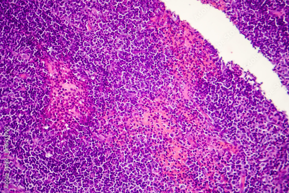 Suppurative appendicitis, light micrograph, photo under microscope ...