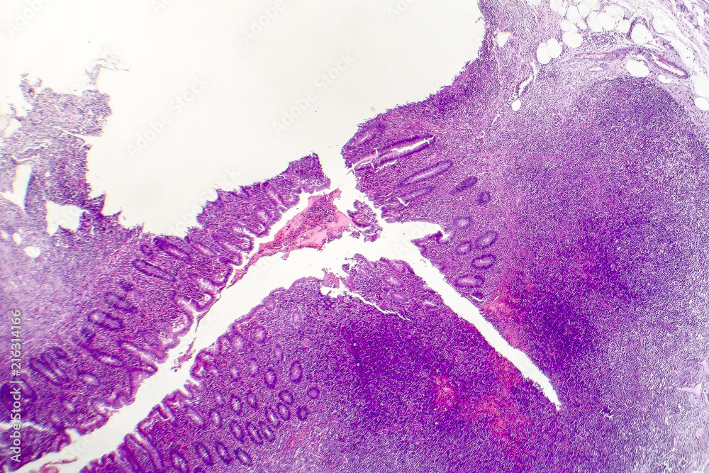 Suppurative appendicitis, light micrograph, photo under microscope ...