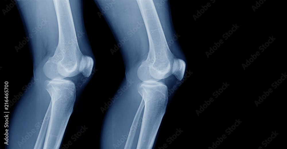 x-ray knee lateral view Stock Photo | Adobe Stock