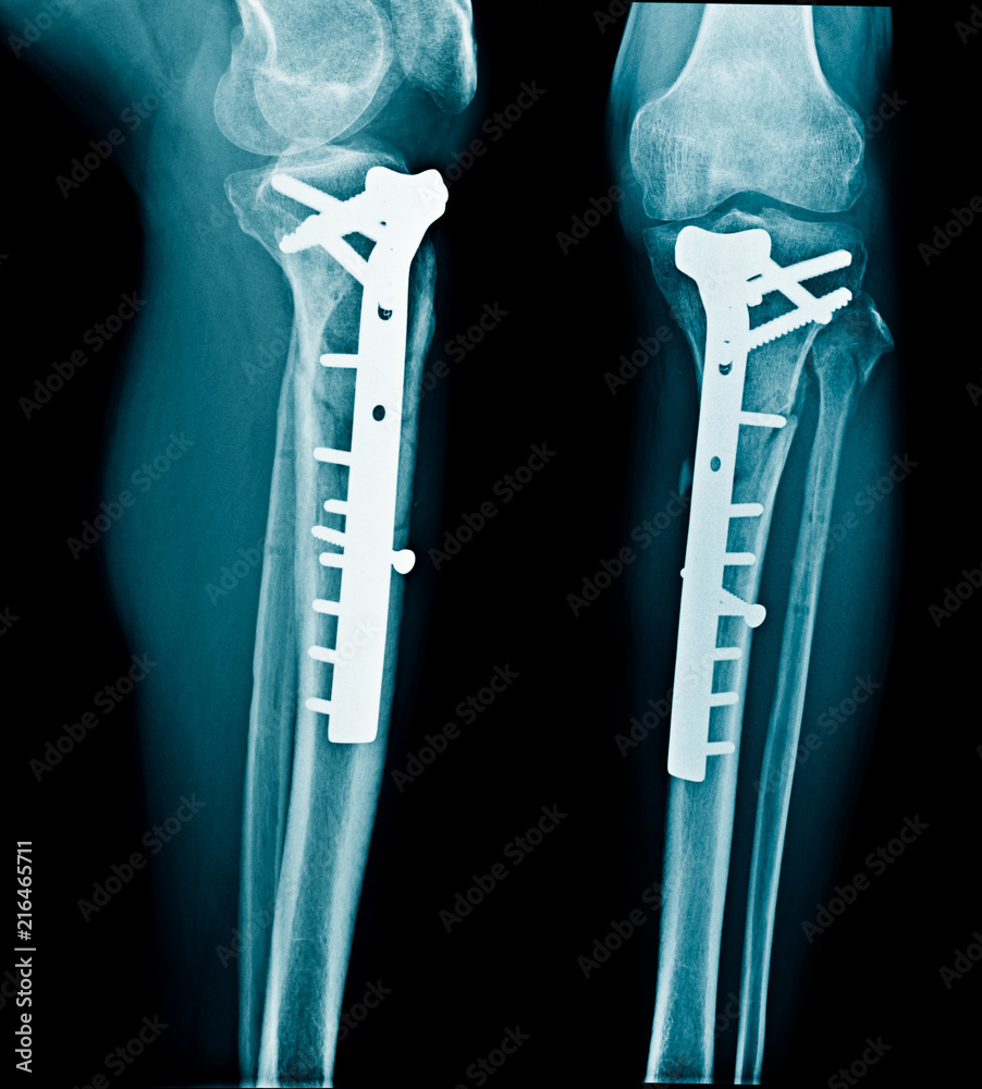 x-ray image internal fixation proximal tibia Stock Photo | Adobe Stock