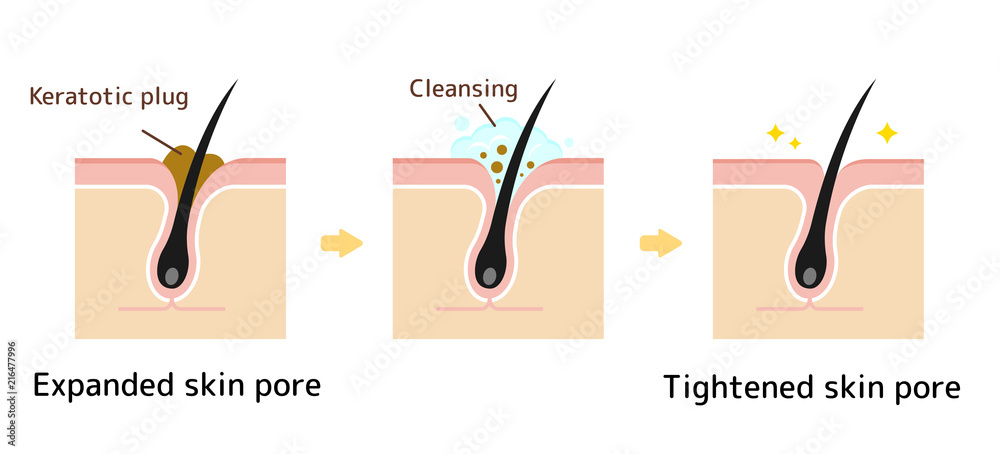 Structure illustration of pores / Clear keratotic plug (whiteheads ...