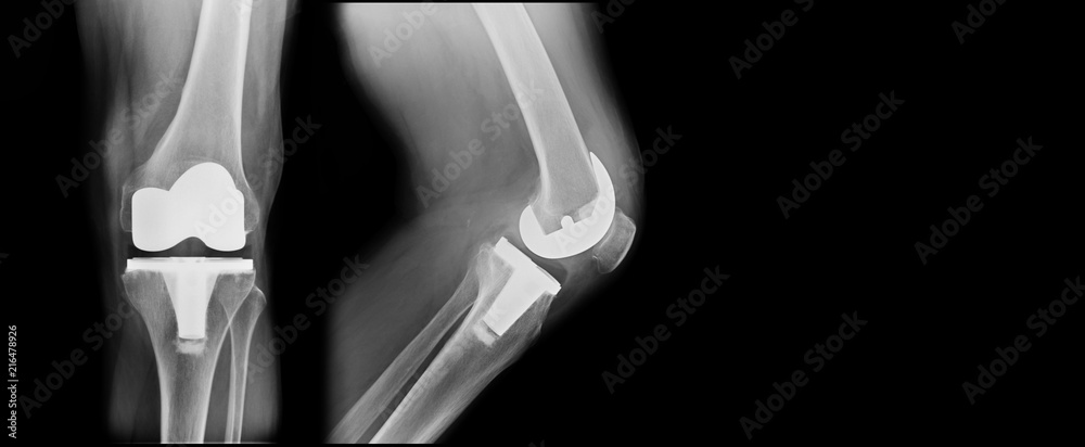 Poster TKA x-ray, total knee replacement frontal and lateral view ...