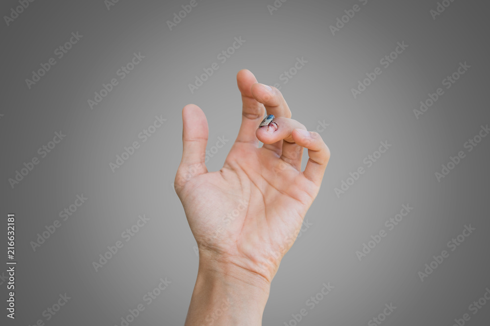 Hand and finger injury with pinch point, a thumb with black bruised ...