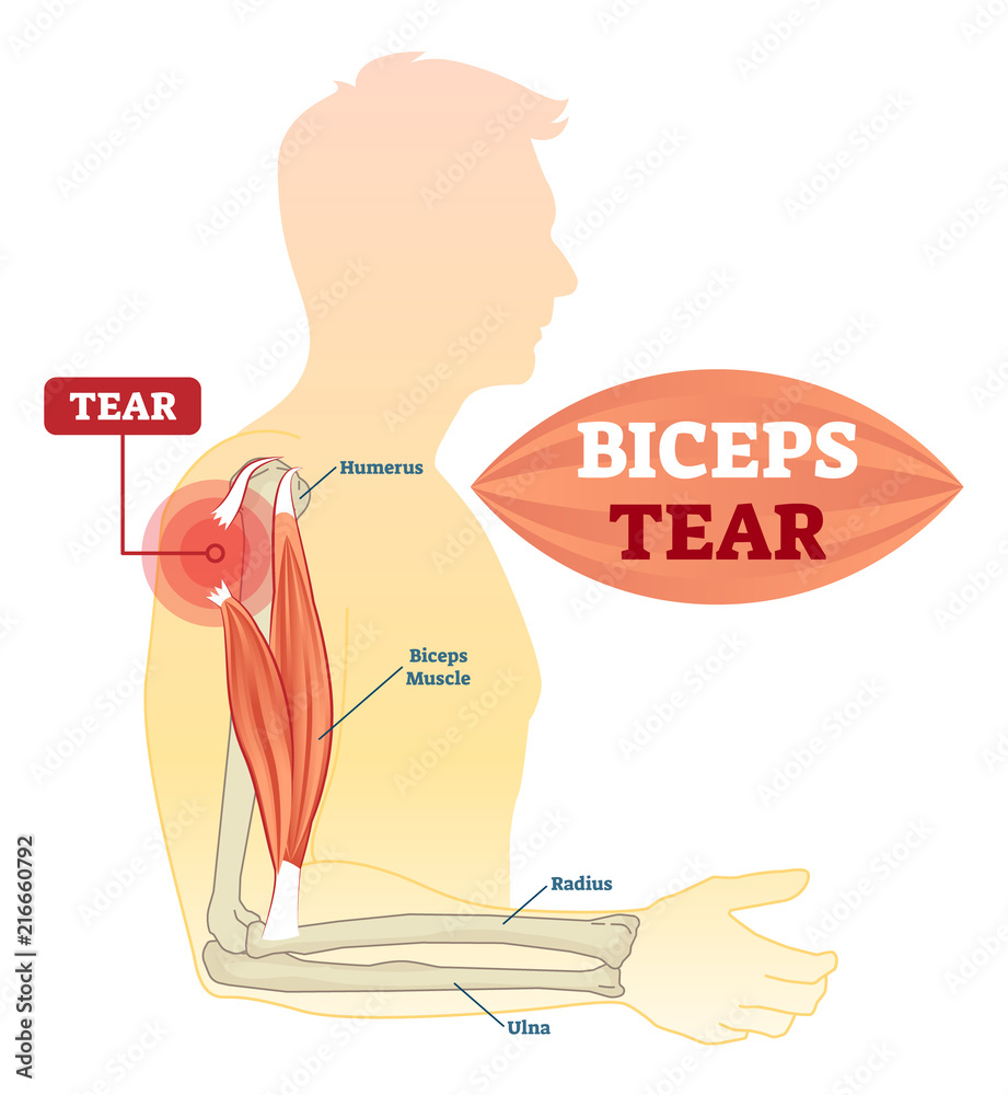 Biceps tear vector illustration. Labeled medical scheme with humerus ...