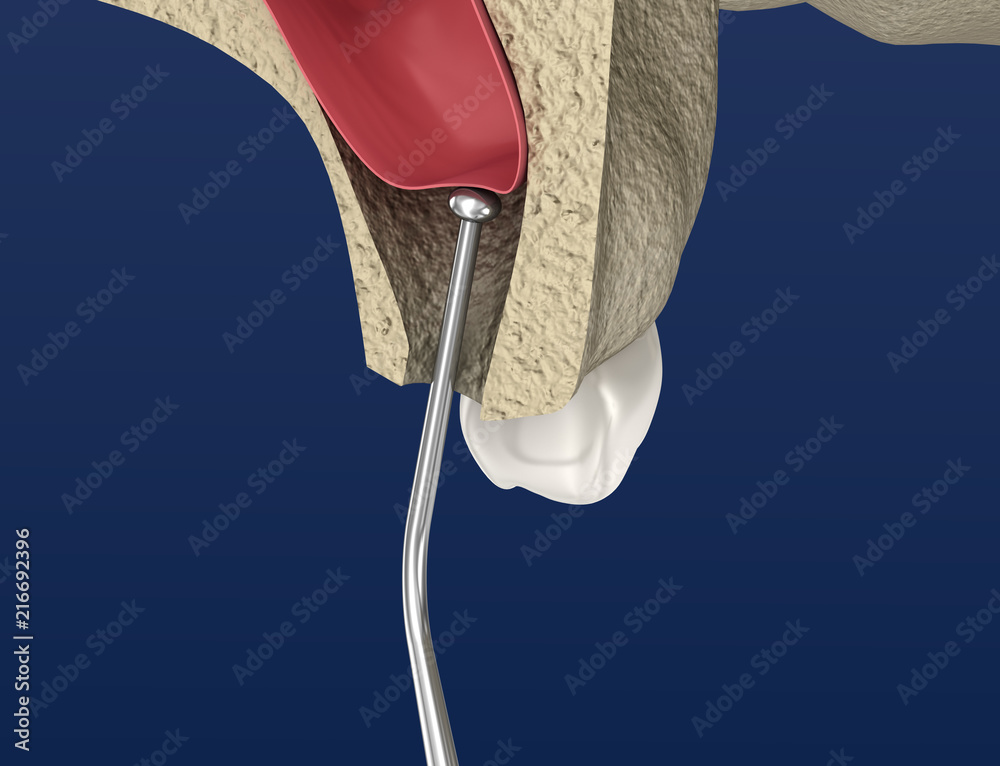 Sinus Lift Surgery - Sinus Augmentation. 3D illustration Stock Photo ...