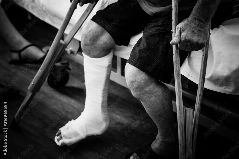 An old man with a plaster on his broken leg sitting on a bed in ...