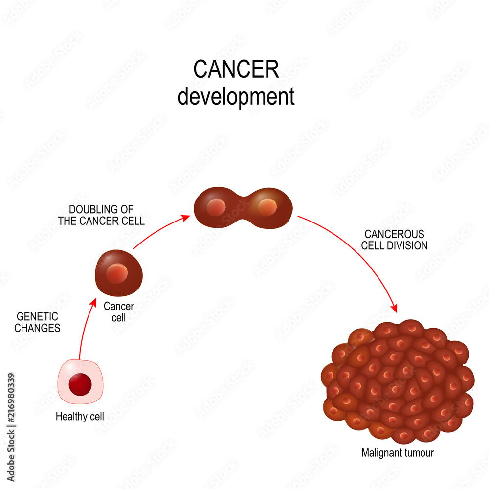 Poster Cancer cell. illustration showing cancer disease development ...