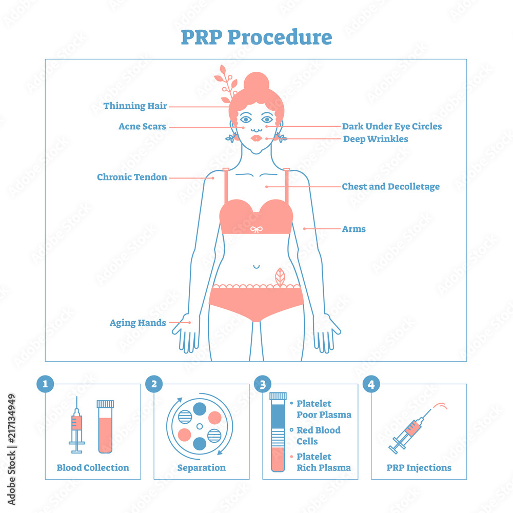 PRP Procedure vector illustration graphic diagram, cosmetology ...