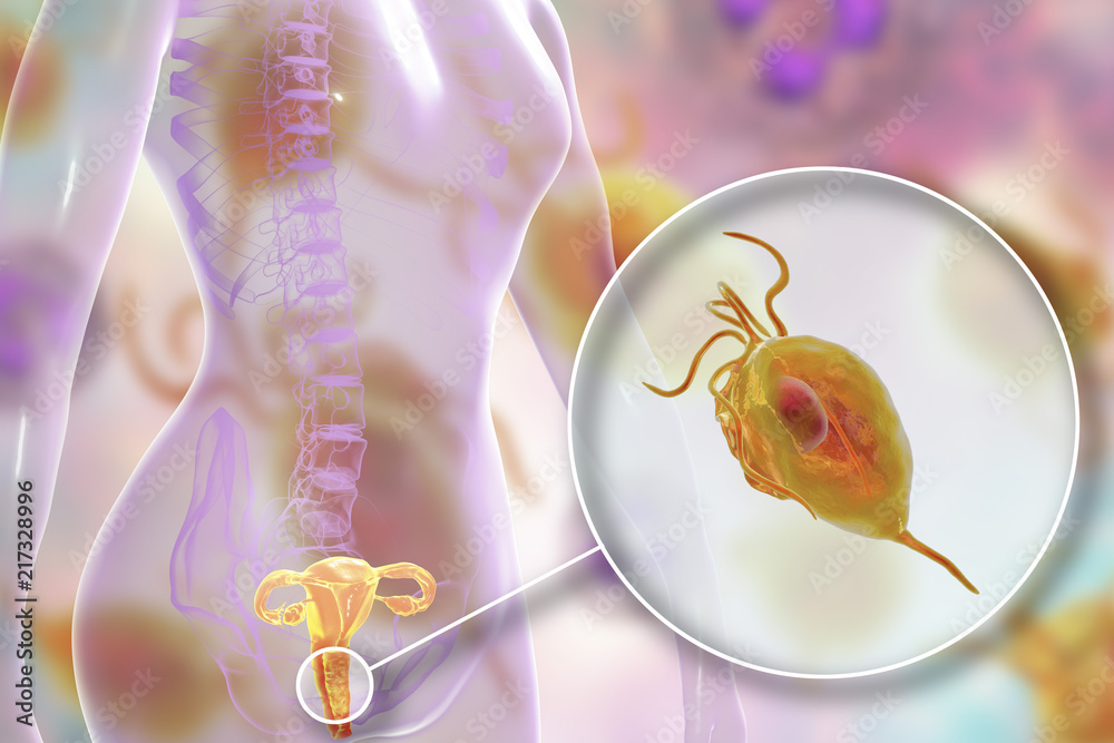 Female trichomoniasis, 3D illustration showing vaginitis and close-up ...