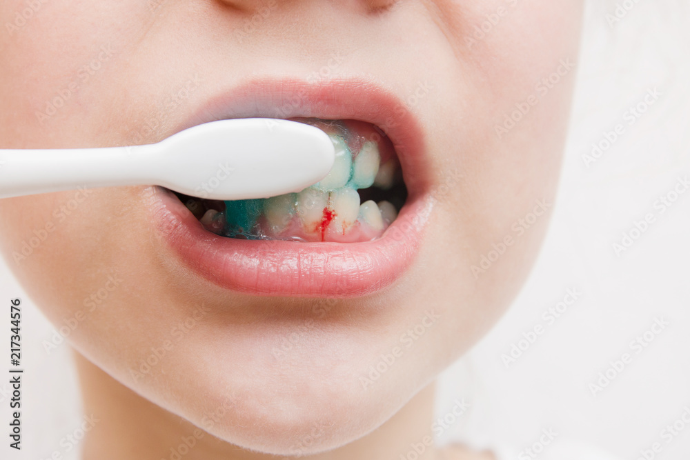 Bleeding at teeth during brushing with toothbrush.bleeding gums Stock ...