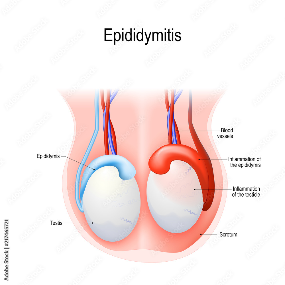 Epididymitis Is Inflammation Of The Epididymis Of The Testicle Stock