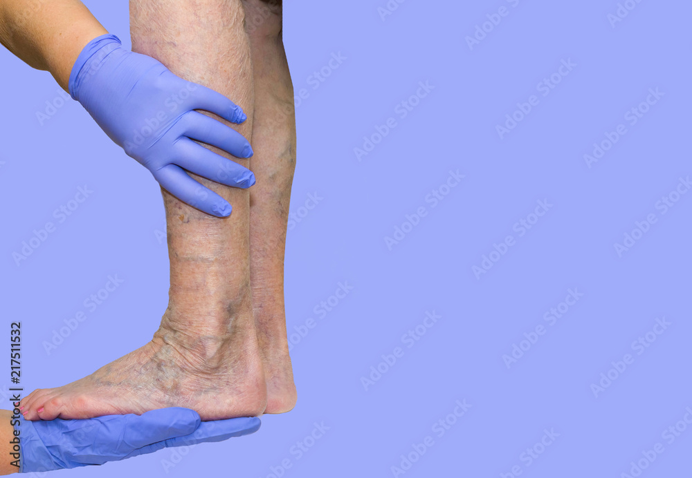Lower limb vascular examination because suspect of venous insufficiency ...