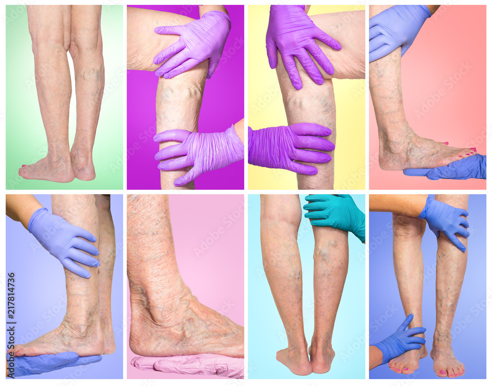 Lower limb vascular examination because suspect of venous insufficiency ...