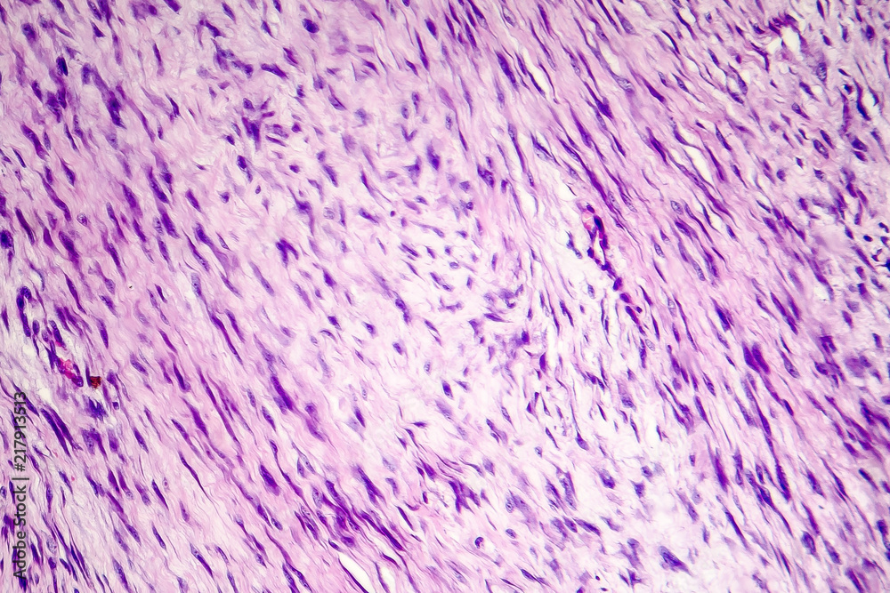 Fibroma, a benign tumour of fibrous tissue, light micrograph, photo ...
