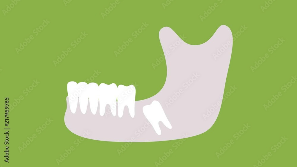 set of type of wisdom tooth in mandible or lower jaw - dental cartoon ...