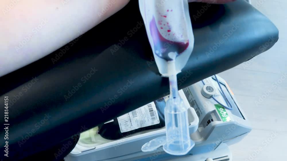 Close up, Blood Collection Equipment and slowly shows Blood Donors Arm ...