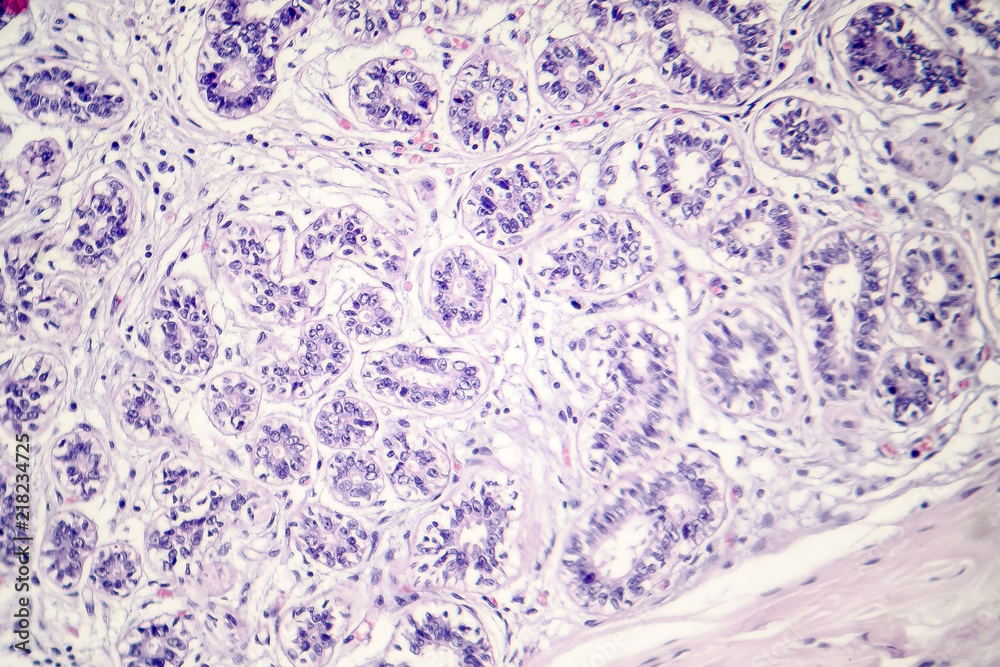 Hard breast cancer, light micrograph, photo under microscope Stock ...