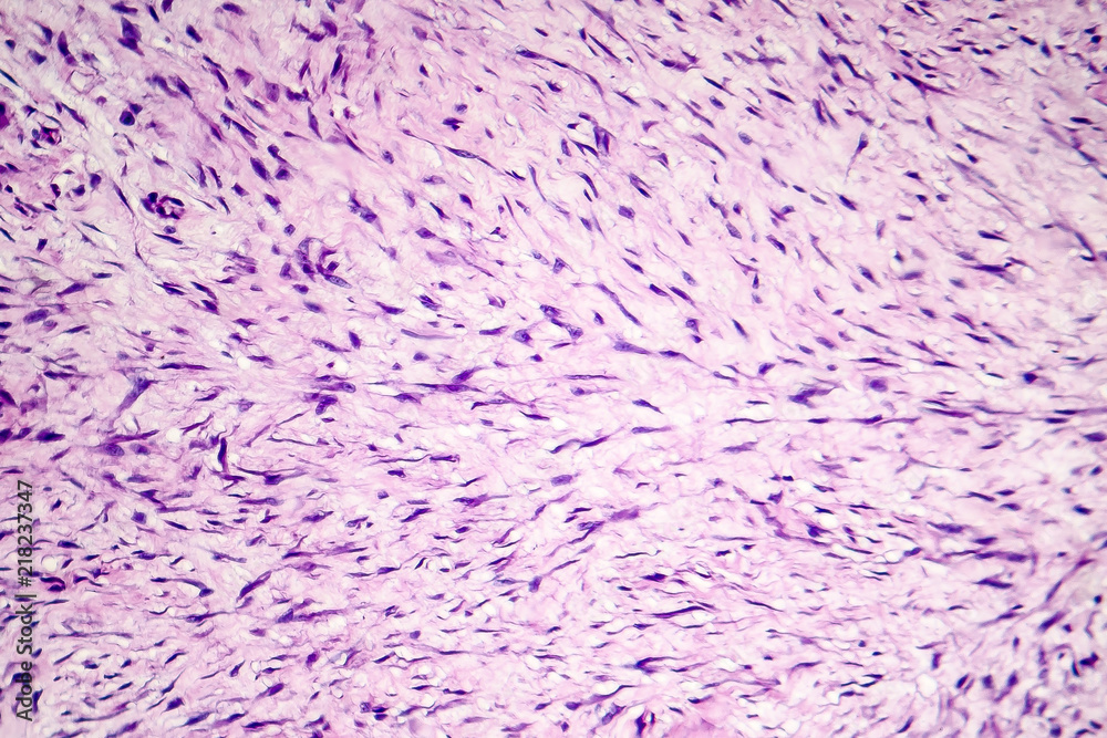 Foto de Fibroma, a benign tumour of fibrous tissue, light micrograph ...