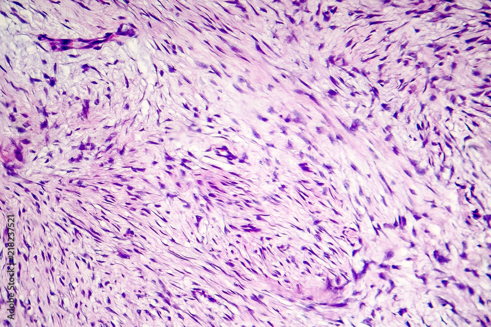 Fibroma, a benign tumour of fibrous tissue, light micrograph, photo ...