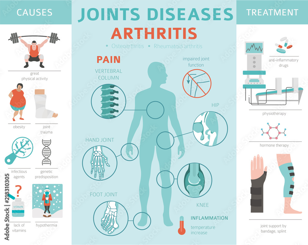 Arthritis Infographic
