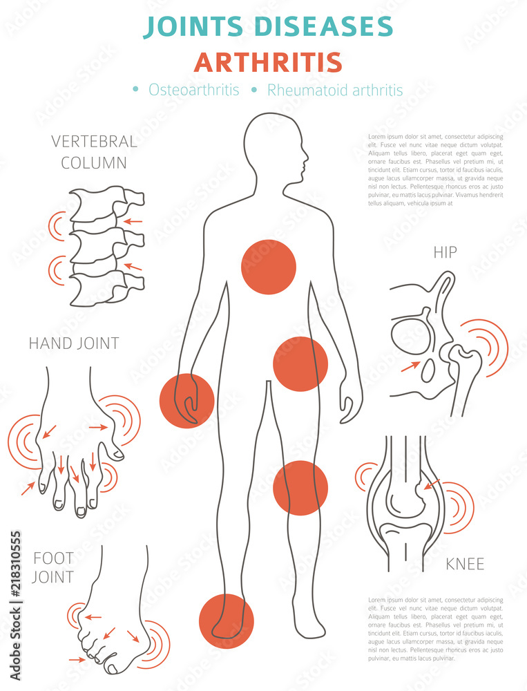 Joints diseases. Arthritis symptoms, treatment icon set. Medical ...