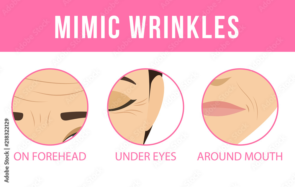 Different types of facial wrinkles. Age-related skin changes. Vector ...