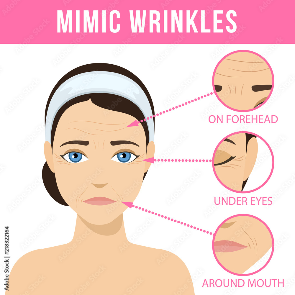 Different types of facial wrinkles. Age-related skin changes. Vector ...