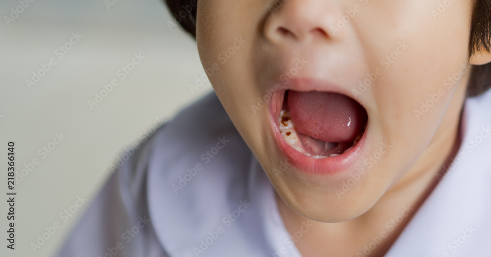 baby mouth, caries, decayed tooth, dirty mouth, dirty teeth Stock Photo ...