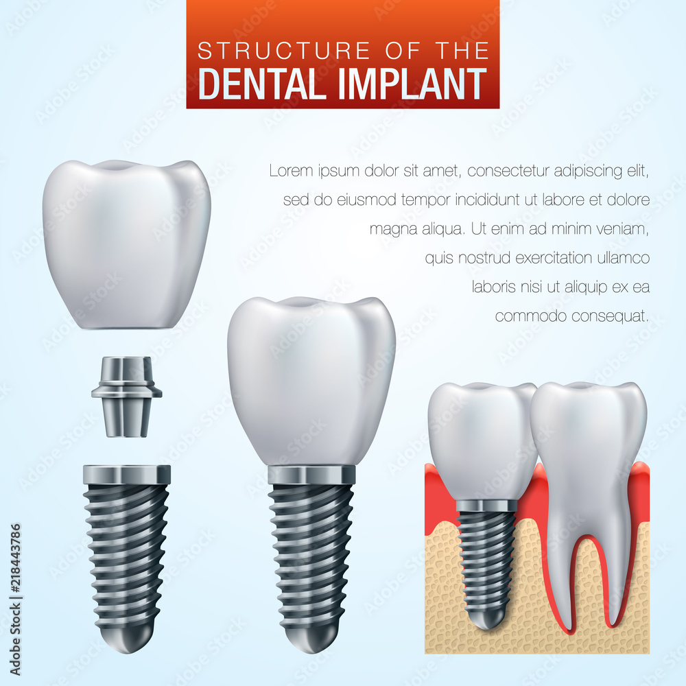 Dental implant vector illustration - humant teeth medical infographic ...