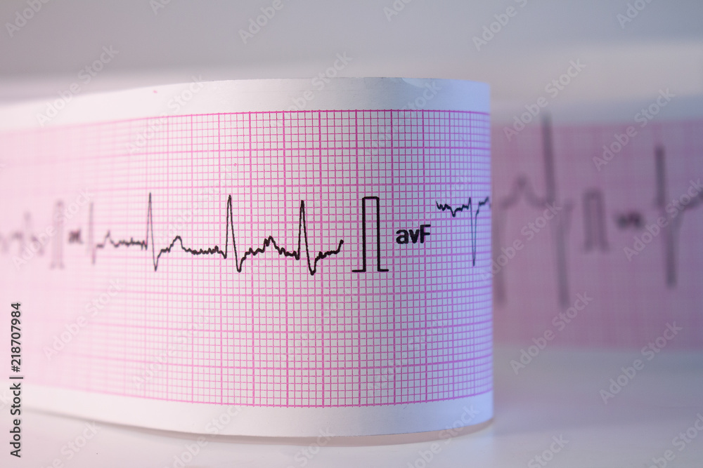 Approach of an electrocardiogram strip with cardiac electrical waves ...