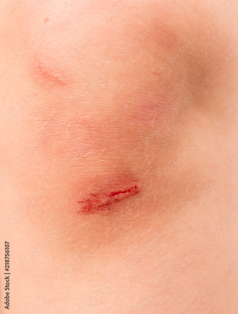 wound on the child's knee Stock Photo | Adobe Stock