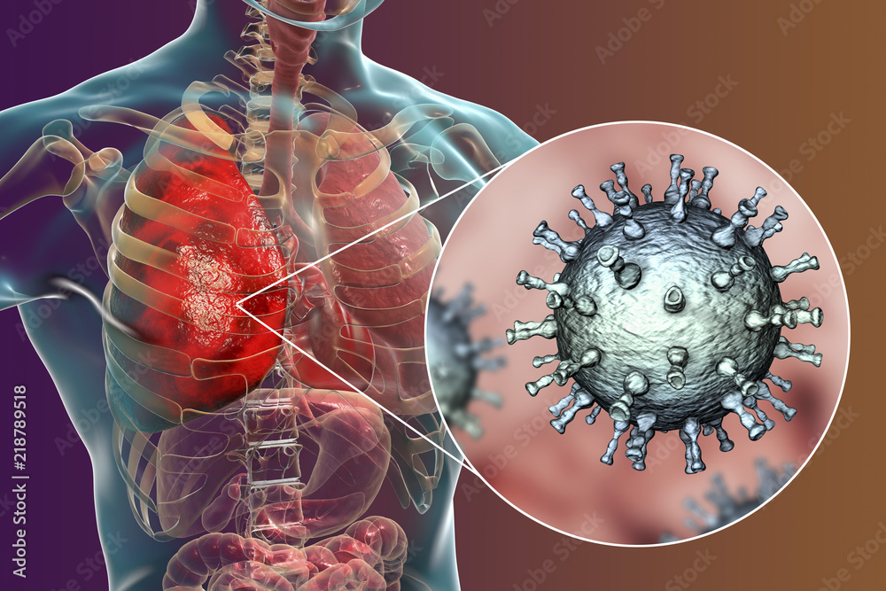 Varicella zoster virus pneumonia, chickenpox complication, 3D ...