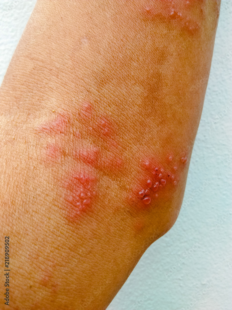 Herpes zoster occurs at the human arm. Stock Photo | Adobe Stock