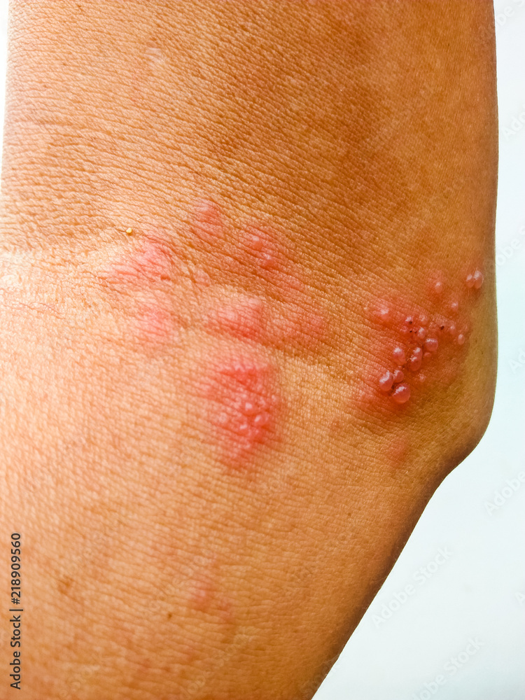 Herpes zoster occurs at the human arm. Stock Photo | Adobe Stock