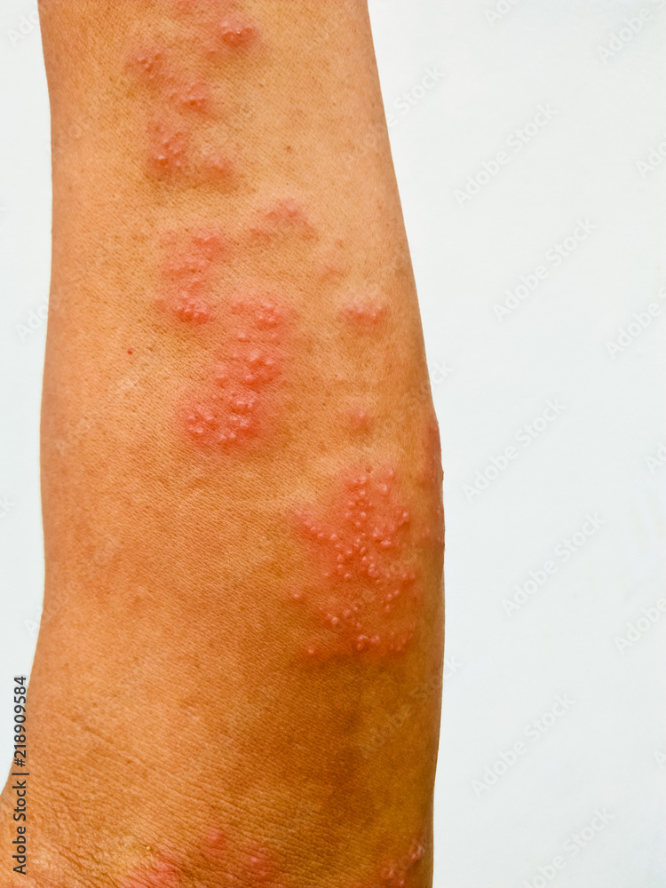 Herpes zoster occurs at the human arm. Stock Photo | Adobe Stock
