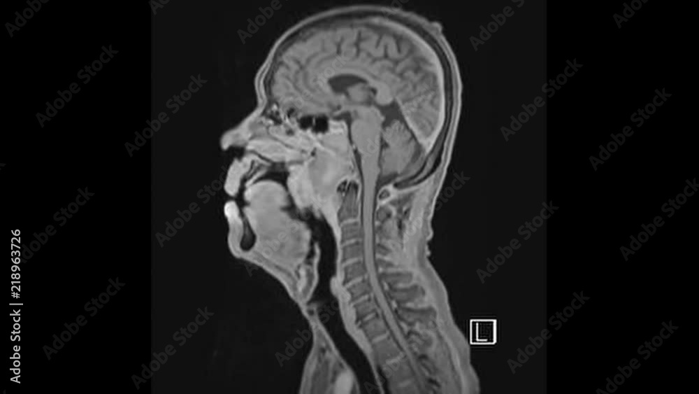 MRI Neck (Lymph node) of Throat cancer smooth motion. Side View Stock ...