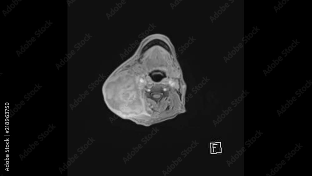 MRI Neck (Lymph node) of Throat cancer smooth motion. Top View Stock ...