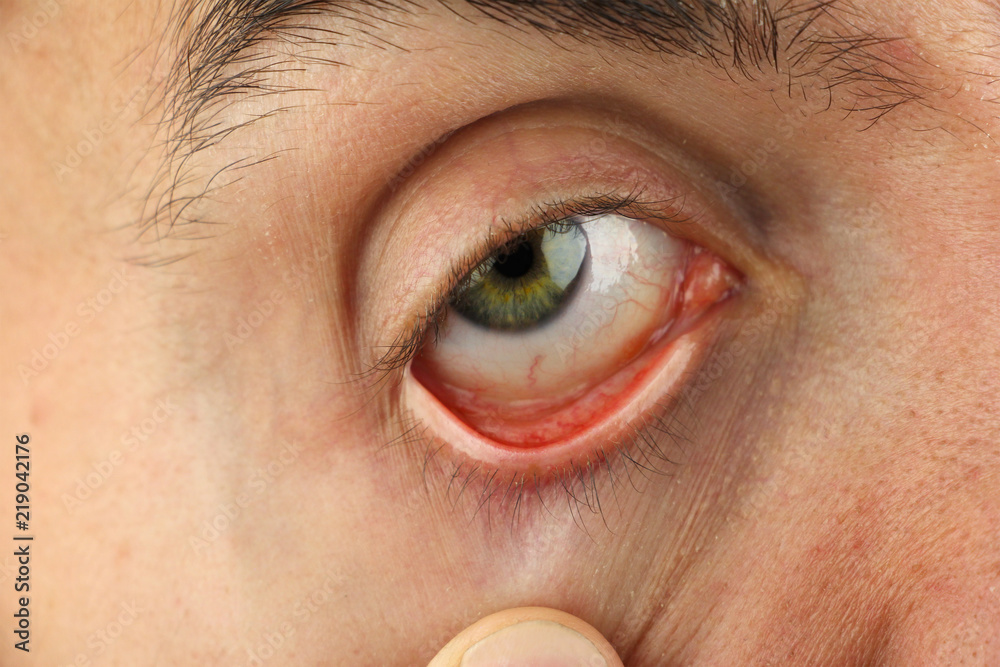 man pulls the lower eyelid to survey the eyeball, closeup macro Stock ...