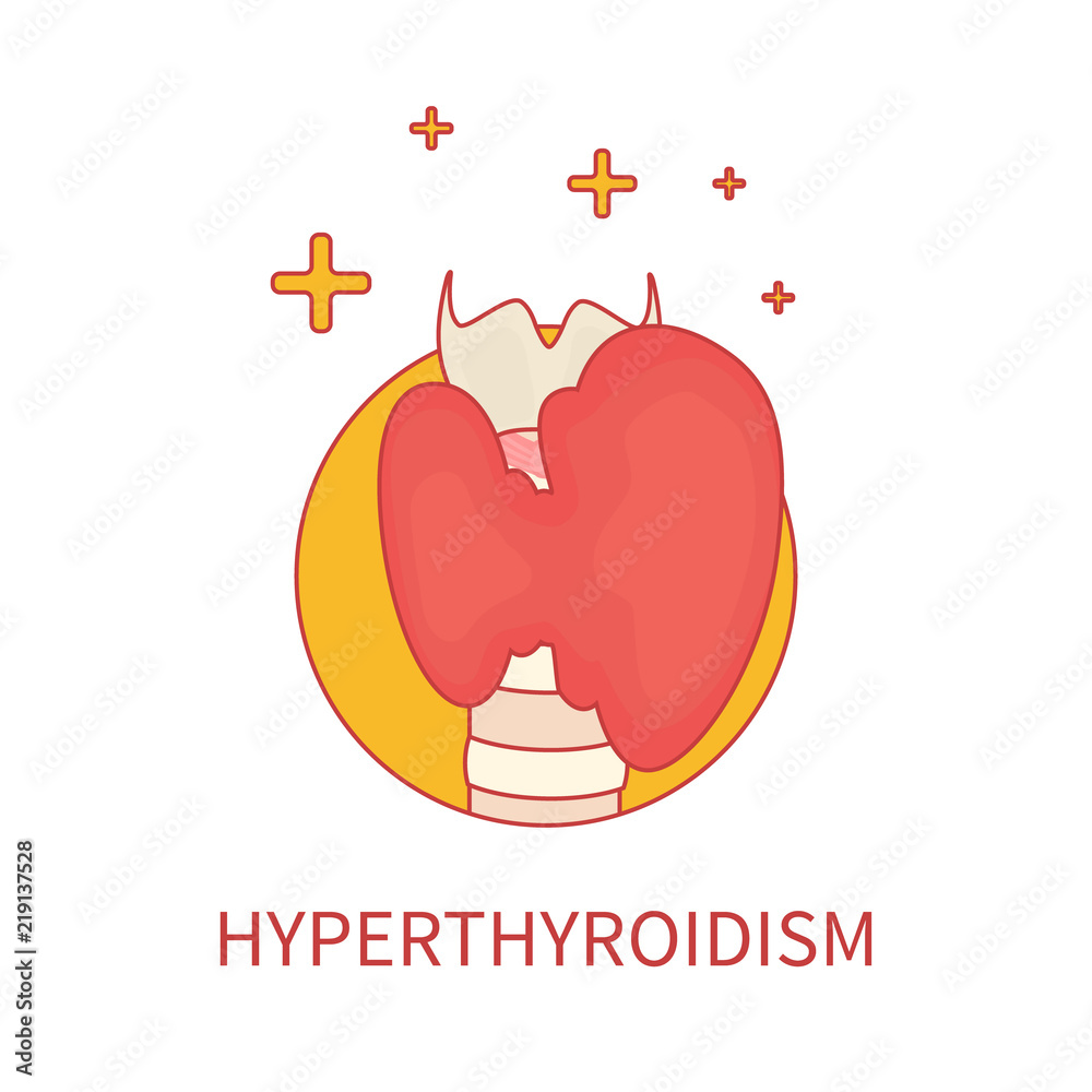 Thyroid gland with swollen lobe on white background. Human body organs ...