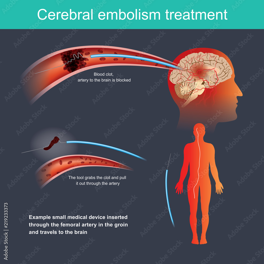 Cerebral embolism treatment. Example small medical device inserted ...