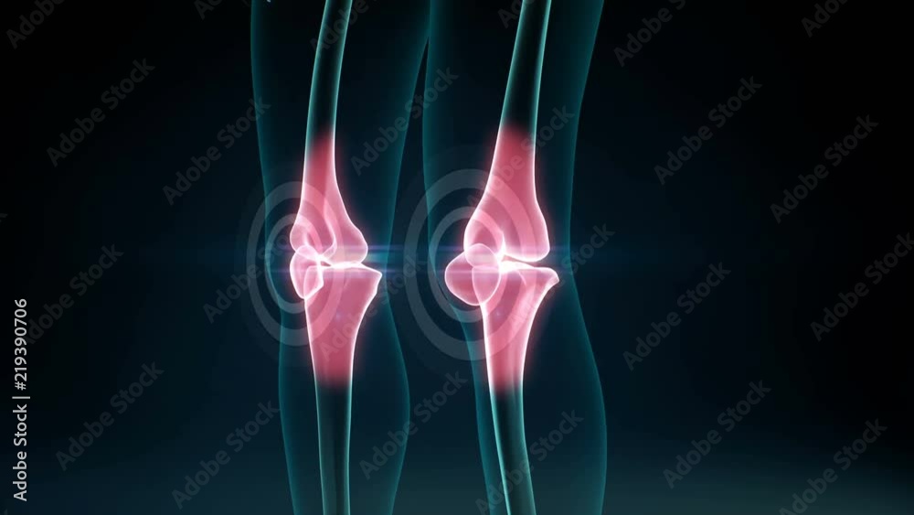 Arthritis of pain Knee. Healthy joint and unhealthy painful joint with ...
