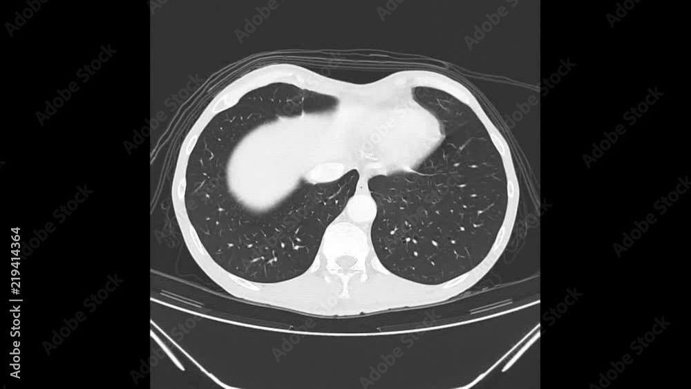 Ct Brain with of Throat cancer. top view Stock Video | Adobe Stock